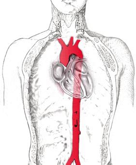 The Authority On A Rare Form Of Heart Disease Department Of Surgery Washington University In