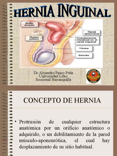 Hernia Inguinal Abdomen Anatomía
