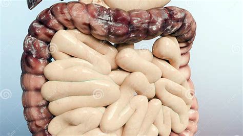 Colorectal Cancer Malignant Tumor In Intestine Endoscope Inside