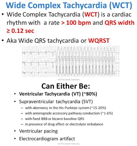 Wide Qrs Complex Tachycardia