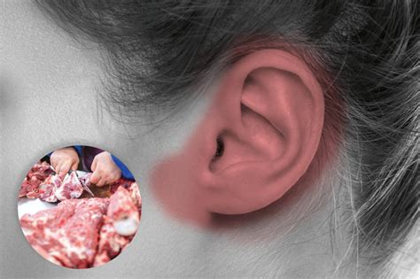 One Health โรคไข้หูดับ