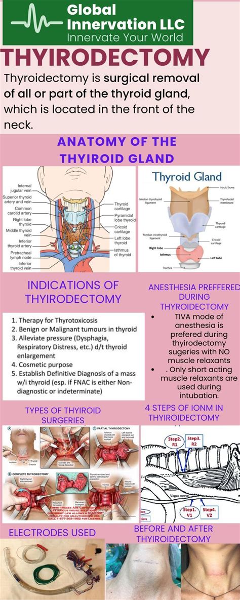 Global Innervation Llc On Linkedin Thyroidectomy Ionm