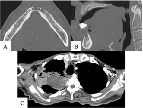 Axial A And Sagittal B Computed Tomography Slices Taken On