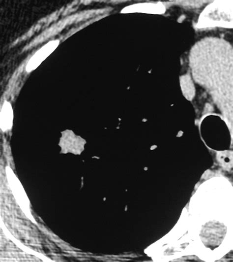 Necrotizing Granuloma Of The Lung Imaging Characteristics And Imaging Guided Diagnosis AJR