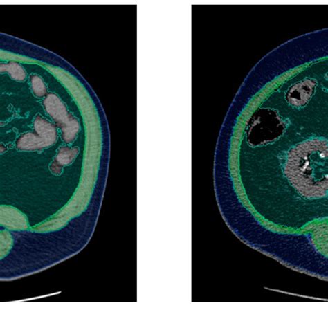 Examples Of Ai Based Analysis Of Body Composition A 65 Year Old Male
