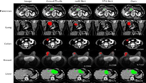 Figure 2 From A Segmentation Foundation Model For Diverse Type Tumors