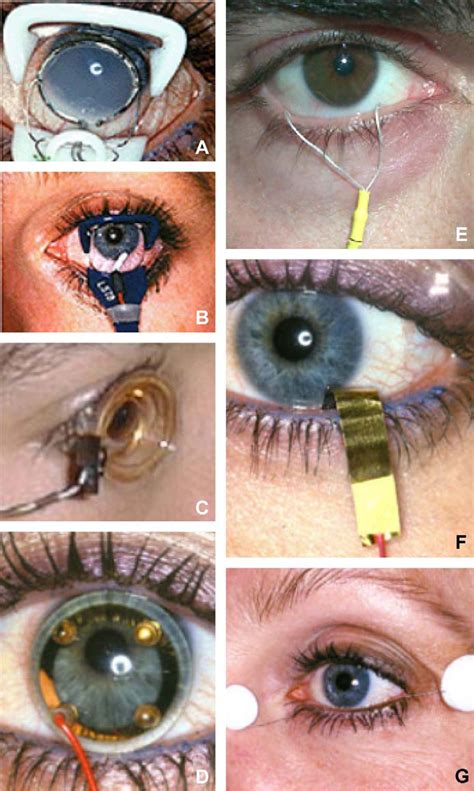 Figure 1 From Non Invasive Electroretinography Semantic Scholar