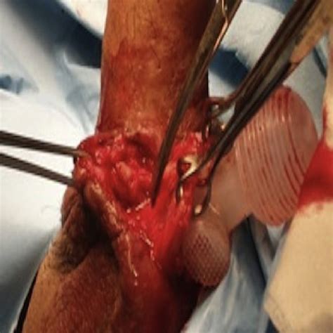 All The Devitalized Tissue Around The Pump Was Removed Download