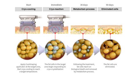 Coolshaping 冷凍溶脂塑形療程 PRO SKINLAB 零銷售保證美容院