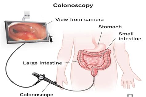 Diagnostic Gi Procedures Landmark Hospital