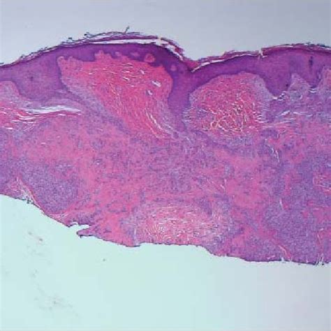 Lobules Of Glycogenated Epithelium With Peripheral Palisading At The