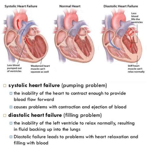 Prognosis Of Left Ventricular Hypertrophy Understanding The Outlook