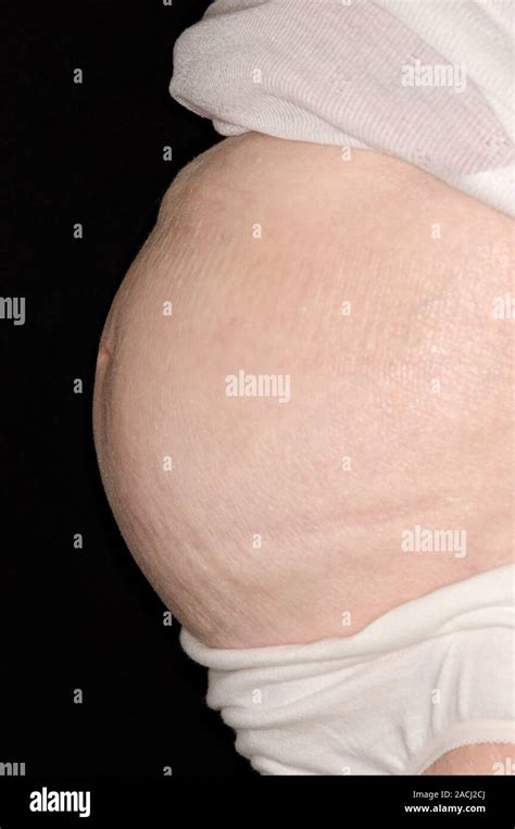 Side View Of The Distended Abdomen In An 82 Year Old Female Patient