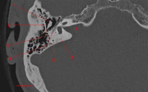 Ct Scan Of The Temporal Bone W Radiology