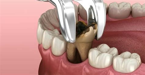 Extraction Of Molar Tooth Damaged By Caries Backgrounds Motion