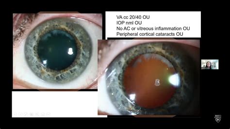 Ophthalmology Grand Rounds 2022 Online Cme Course Mayo Clinic School