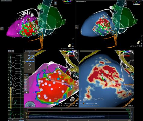 Ablation Procedure Aided By Adas Reconstructed Cmr Sinus Rhythm Download Scientific Diagram