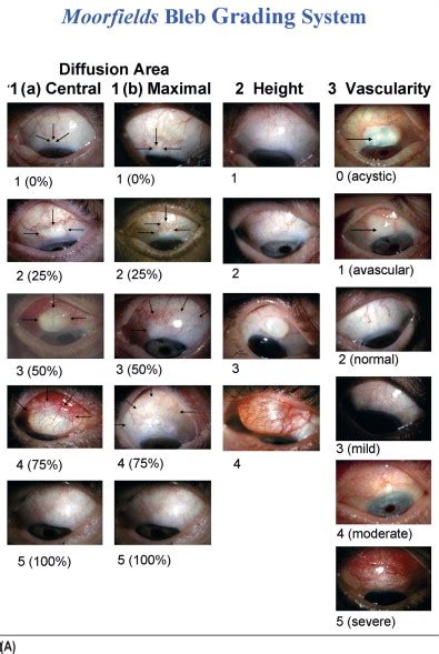 Glaucoma Outflow Procedures Ento Key