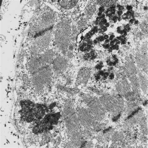 Electron Microscopy Shows Intracytoplasmic Inclusions Consisting Of