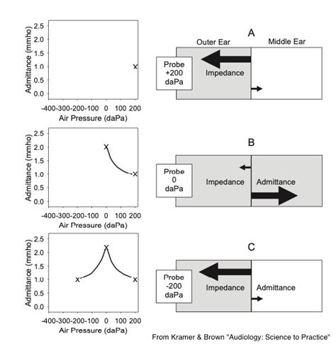 Flat Tympanogram Meaning At David Carrasco Blog