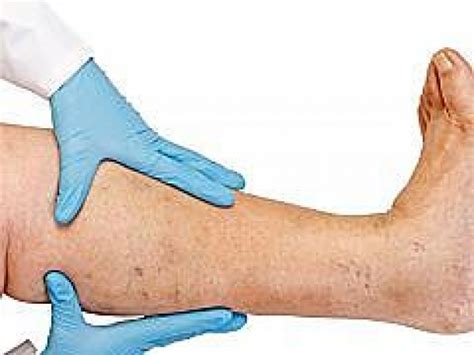 Preventing Gout Flare Ups Artofit