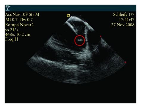 A Mobile Thrombus Encircled Is Attached To The Tip Of The Transseptal Download Scientific