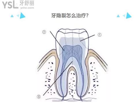 牙隐裂牙套 门牙牙隐裂 补牙牙套 大山谷图库