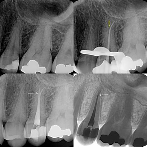 The Short Case Of The Day Tooth Apex Endodontics P C
