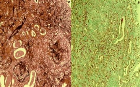 A Glomeruli With Complete Encircling Cellular Crescents Interstitium Download Scientific