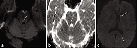 Medial Longitudinal Fasciculus Mri