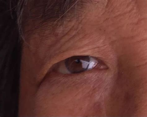 老人眼睛做了个小手术，做完竟然 失明”了？手术医院扬州新浪新闻