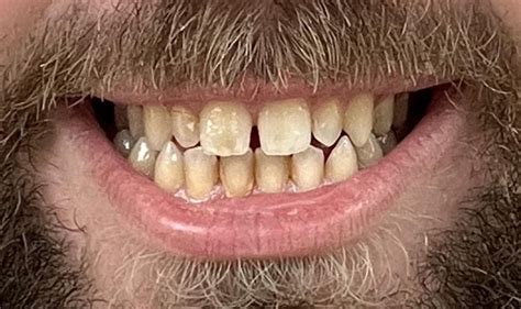 1 Year Difference Not Perfect But Im Happy With The Result R