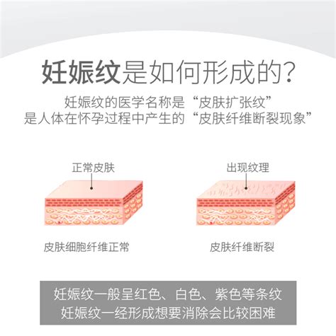 孕纹修护霜 祛孕纹肥胖纹橘皮生长纹产后护理腹部收紧淡纹修护 阿里巴巴