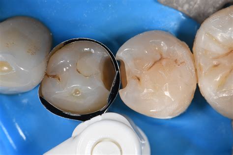 Matrix In Matrix Back To Back Class Ii Matrix In Matrix Back To