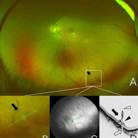Pdf Spectral Domain Optical Coherence Tomography Characteristics Of Cystic Retinal Tuft
