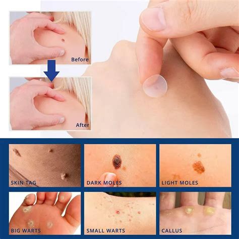 Hold Live Skin Tag Removal 144pcs Skin Tag Remover Patch Warts Remover Ance Pimple Patch Skin