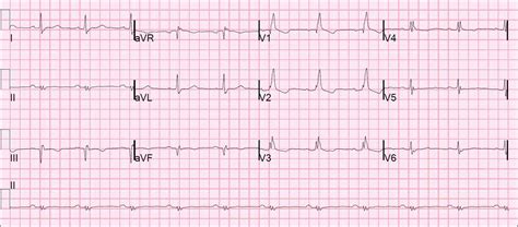 Intermittent Third Degree Heart Block Due To Stuttering Inferior Stemi Dr Smiths Ecg Blog