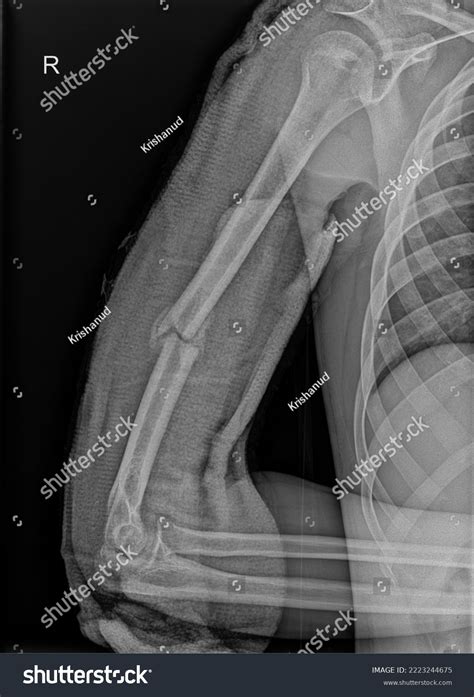 Trauma Xray Upper Limb Humerus Fractures Stockfoto 2223244675