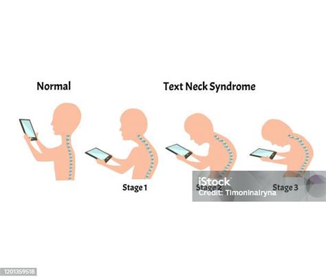 부적절한 자세 증상 무대 텍스트 목 증후군 척추 곡률 척추 후만증 척추 증 척추측만증 관절염 부적절한 자세와 구부리기 인포