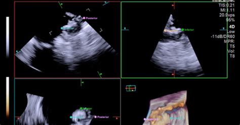 보라매병원 국내 최초 4d 심장내 초음파 활용 좌심방이폐색술 성공