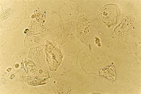 Premium Photo Epithelial Cells With Bacteria In Patient Urine Urinary