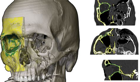 Threshold Segmentation Of Bone Yellow And Atlas Based Segmentation Of Download Scientific