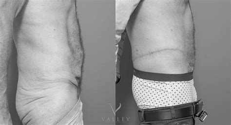 Weight Loss Belt Lipectomy Pauls Patient Story Psh
