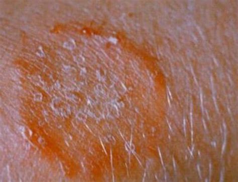 Tinea Infections Ringworm What It Is Causes Symptoms And Treatments