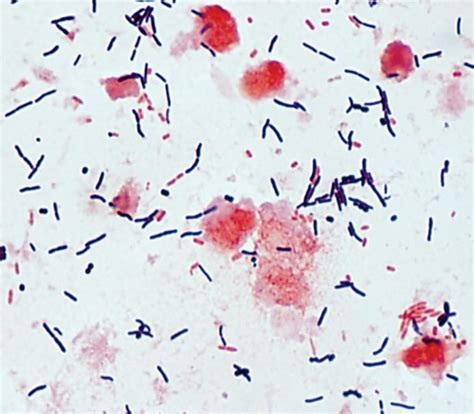클로스트리디움 디피실clostridium Difficile 장염 진단과 치료 네이버 블로그