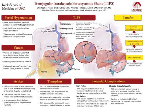 Transjugular Intrahepatic Portosystemic Shunt TIPS アメリカ肝臓財団