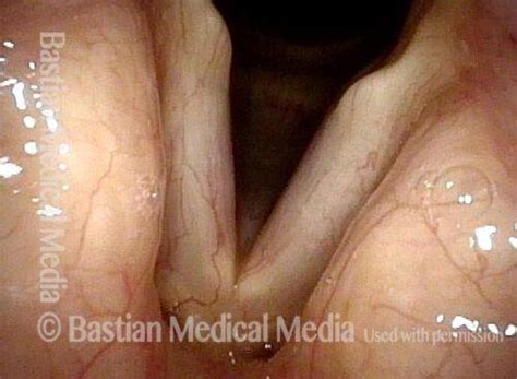 Candida Laryngitis And Pharyngitis A Commensal Organism