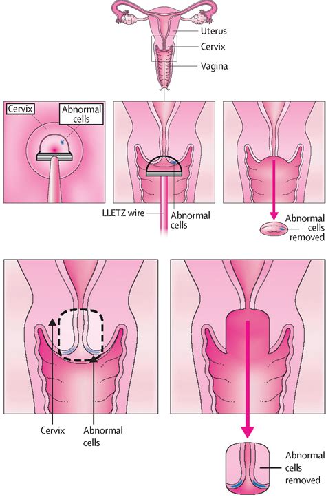 Terminology For Cone Dimensions After Local Conservative Treatment For