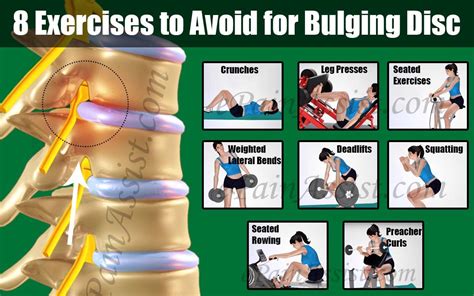 Disc Bulge Exercise At Malik Keck Blog