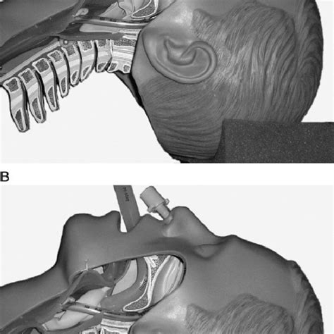 A Insertion Of A Laryngeal Mask Airway Lma Lma North America San